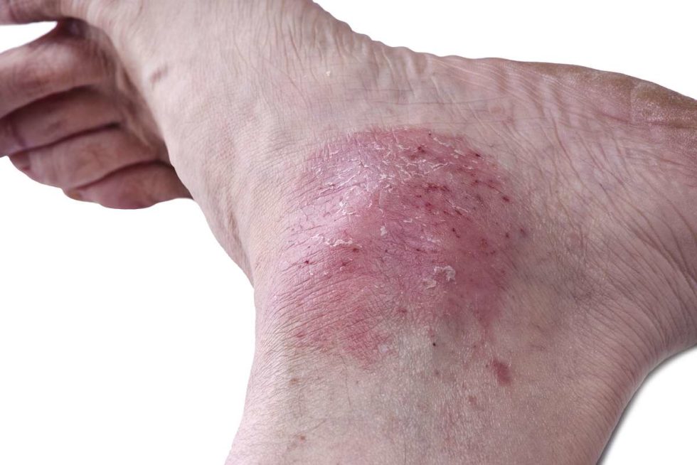Schuppenflechte Bilder Wir zeigen dir Psoriasis in Bildern